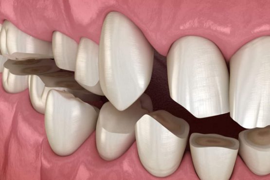 Cómo arreglar una muela rota | Empaste, Corona| Lixdent