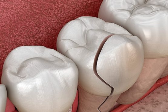 Cómo arreglar una muela rota | Empaste, Corona| Lixdent