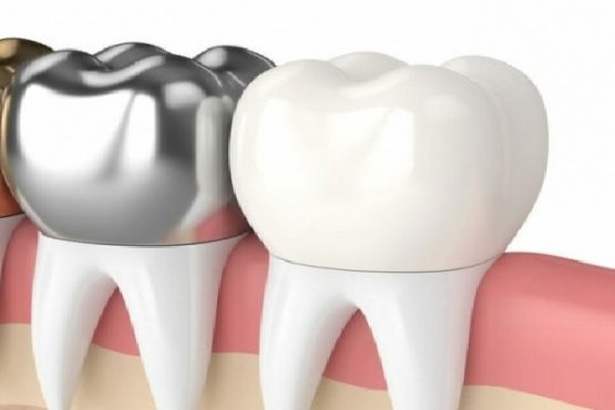 Cómo arreglar una muela rota | Empaste, Corona| Lixdent