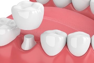 Cómo arreglar una muela rota | Empaste, Corona| Lixdent