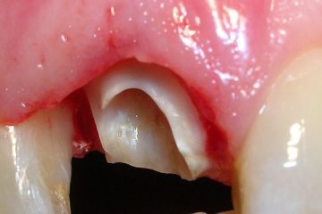 Cómo arreglar una muela rota | Empaste, Corona| Lixdent