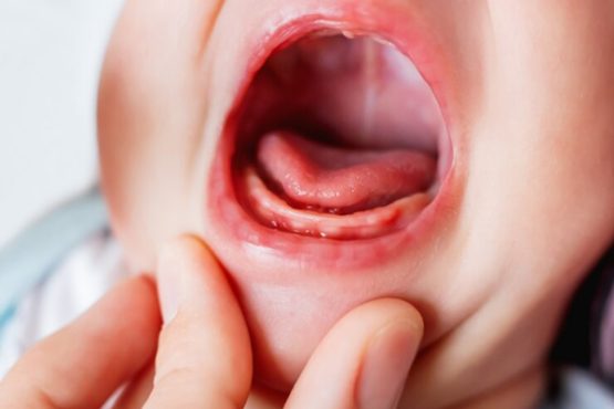 Anodoncia, ¿Qué es? Causas y tratamiento – LixDent