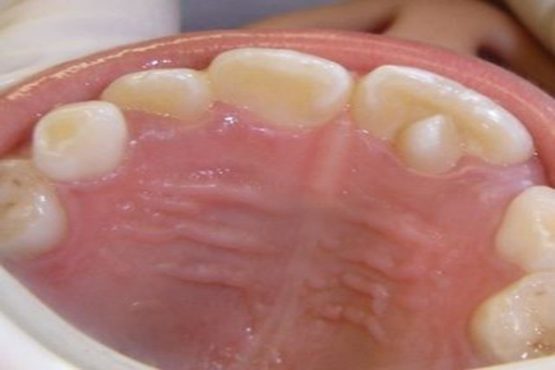 Talón cuspídeo dental – LixDent